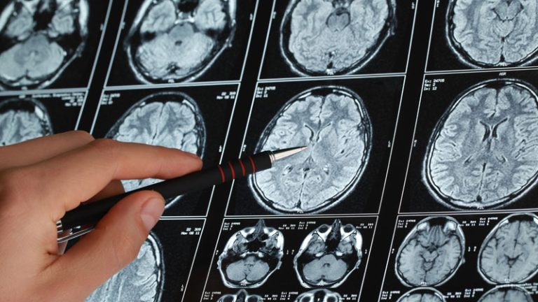 Gadolinium based Contrast Agents (GBCAs) in Magnetic Resonance Imaging ...